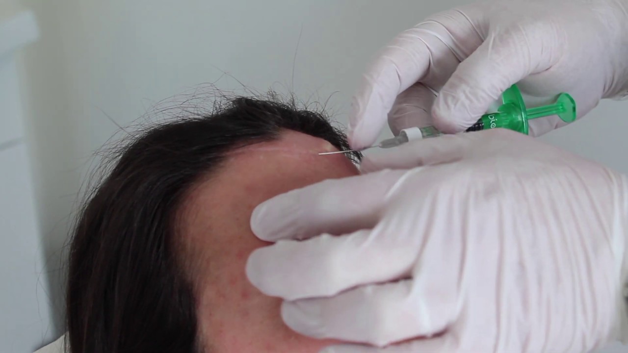 Bioregen SCARS TREATMENT - YouTube
