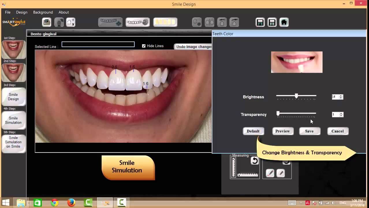 Smart Smile Design - Design Extras (Part 2) - YouTube