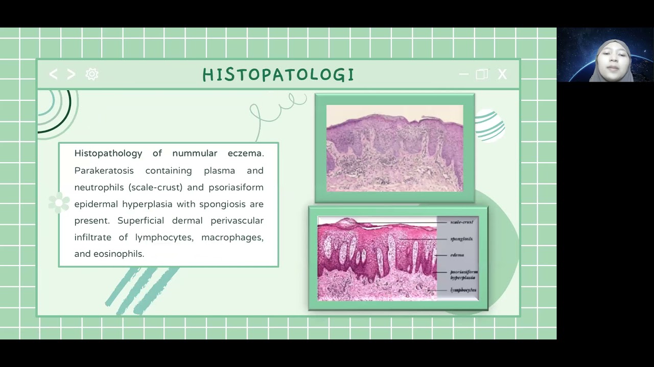 DERMATITIS NUMULARIS - YouTube