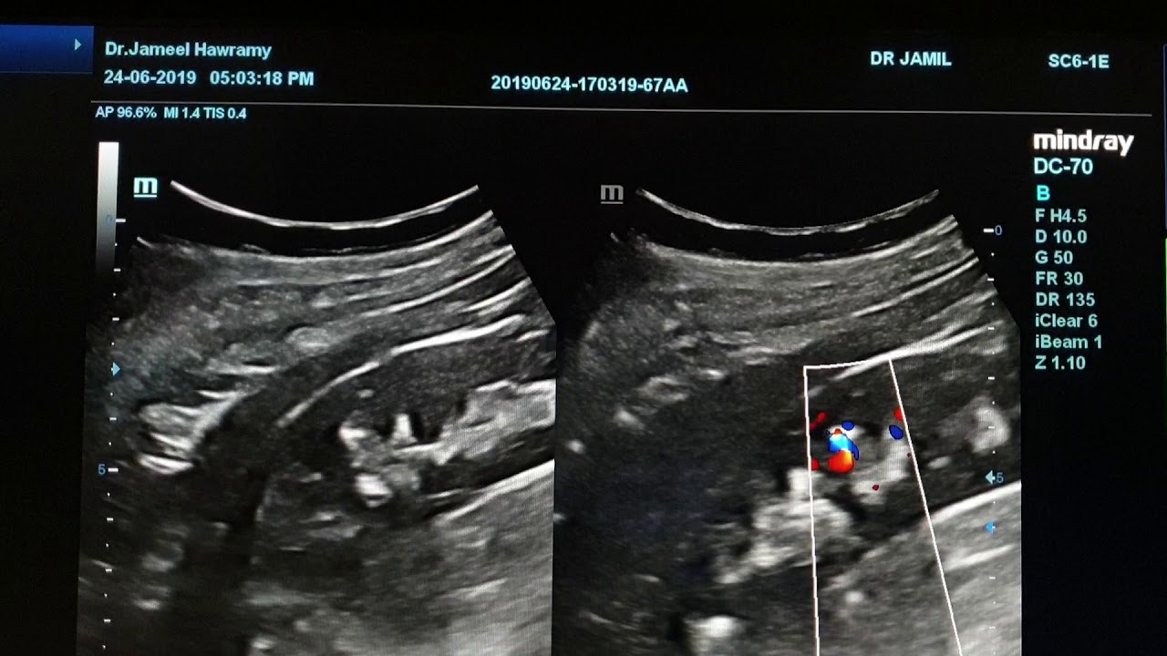 Milk of Calcium Sonography - YouTube