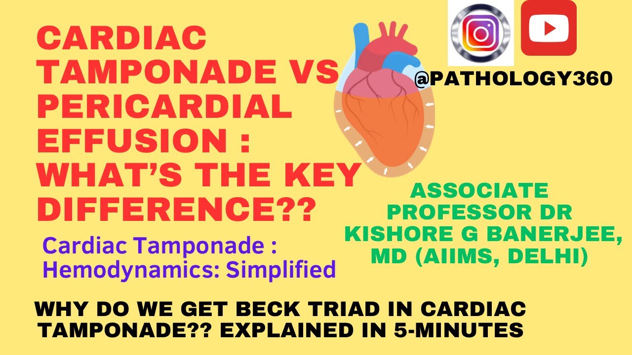 Pericardial Effusion Vs Cardiac Tamponade
