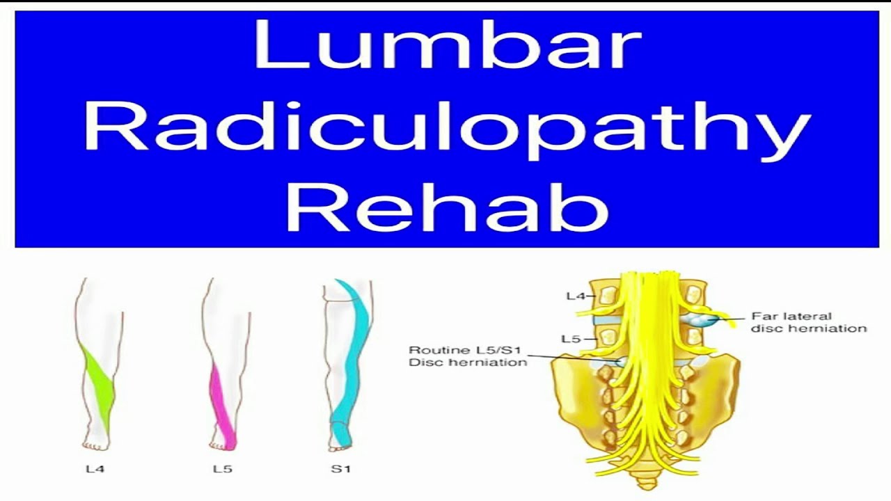 Lumbar Spine Rehab: Radiculopathy Sciatica, Lumbar Nerve Root ...