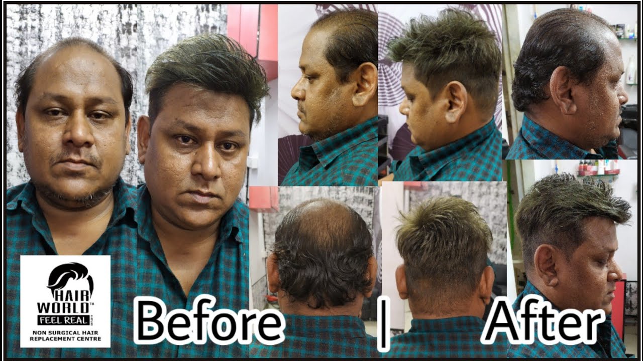 Best Hair Fixing For Men | Hair Patch | Best Hair System | Best Hair ...