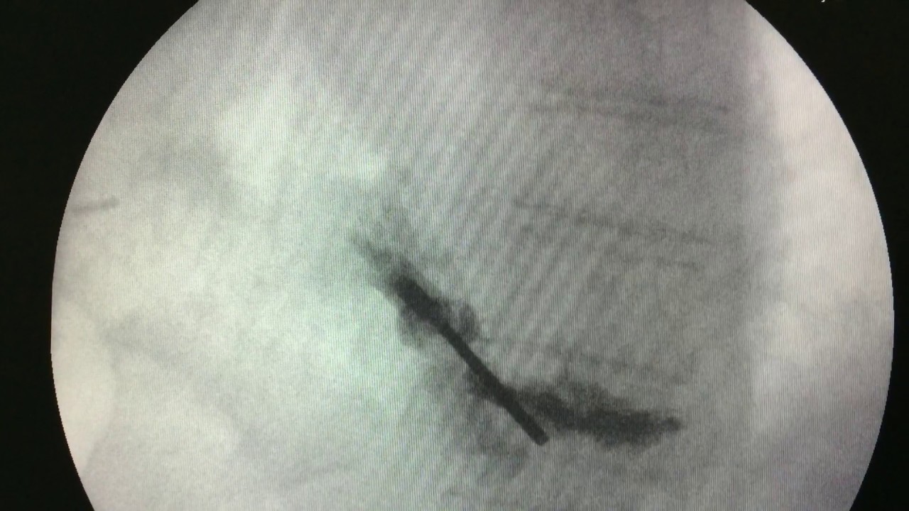 Percutaneous Vertebroplasty in a 93yr old patient with Osteoporotic D11 ...