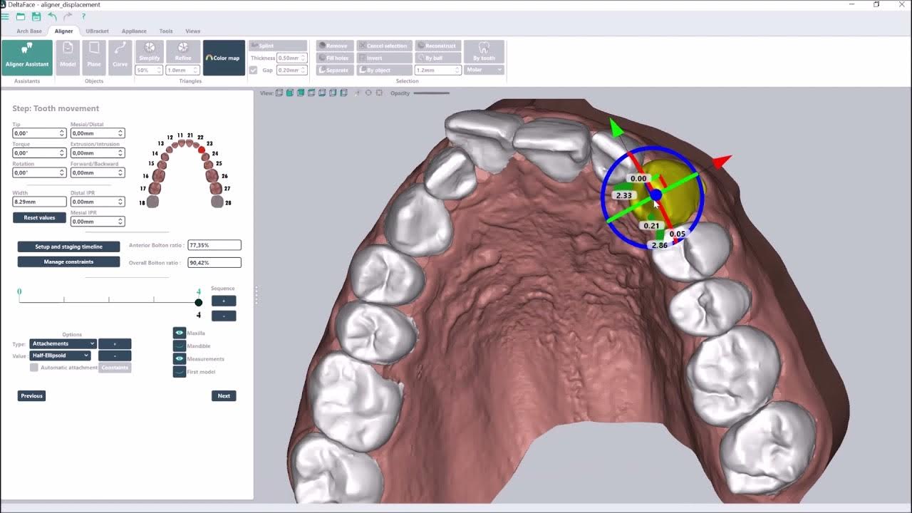 Direct printing of aligners - Deltaface orthodontic software - YouTube