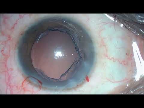 PHACO IN SOFT CATARACT WITH IMPRESSE HOYA IOL - YouTube