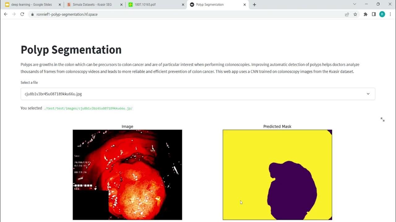 Polyp Segmentation For Automatic Colonoscopy Analysis Youtube