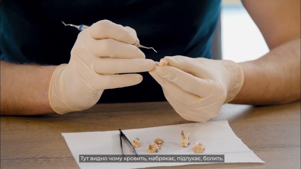Чому у людей випадають зуби? - YouTube