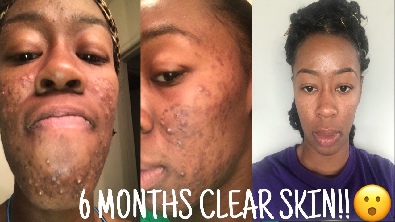 10 YEARS OF ACNE GONE!│ACNE TREATMENT - YouTube