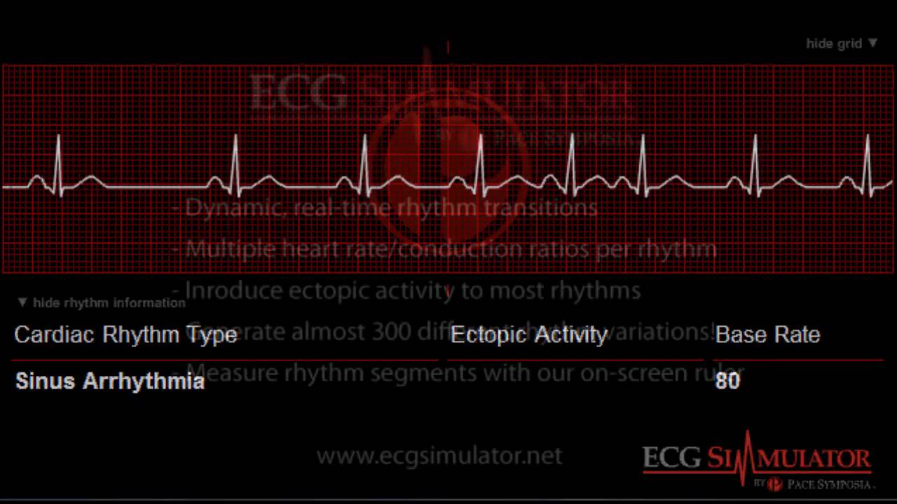 Sinus Arrhythmia ECG / EKG (ecgsimulator.net) - YouTube