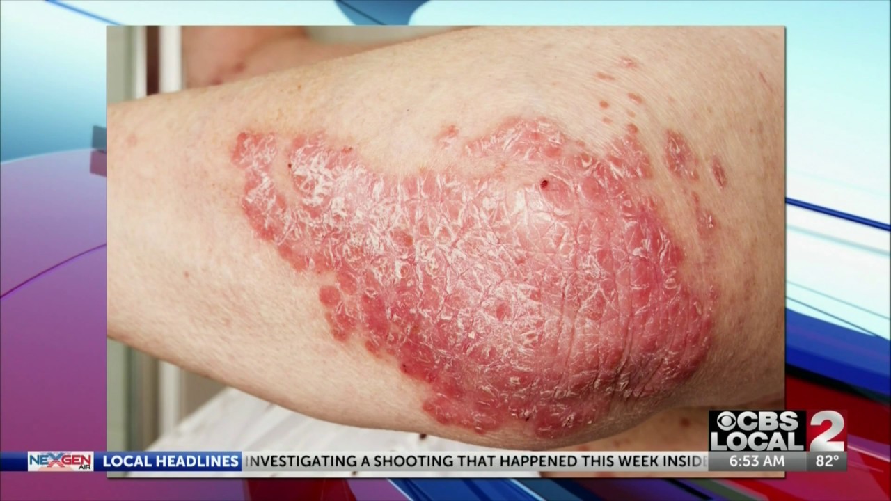 Psoriasis Eczema Clinical Research Studies For New Oral Medication psoriasis-eczema-clinical-research-studies-for-new-oral-medication