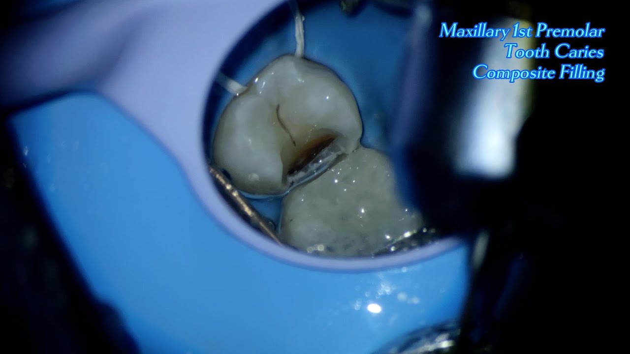 Maxillary 1st Premolar Tooth Caries fixed with Composite Filling (Diş ...