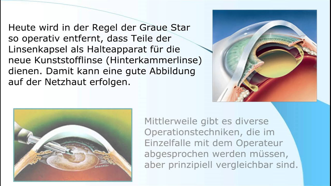 Katarakt Op