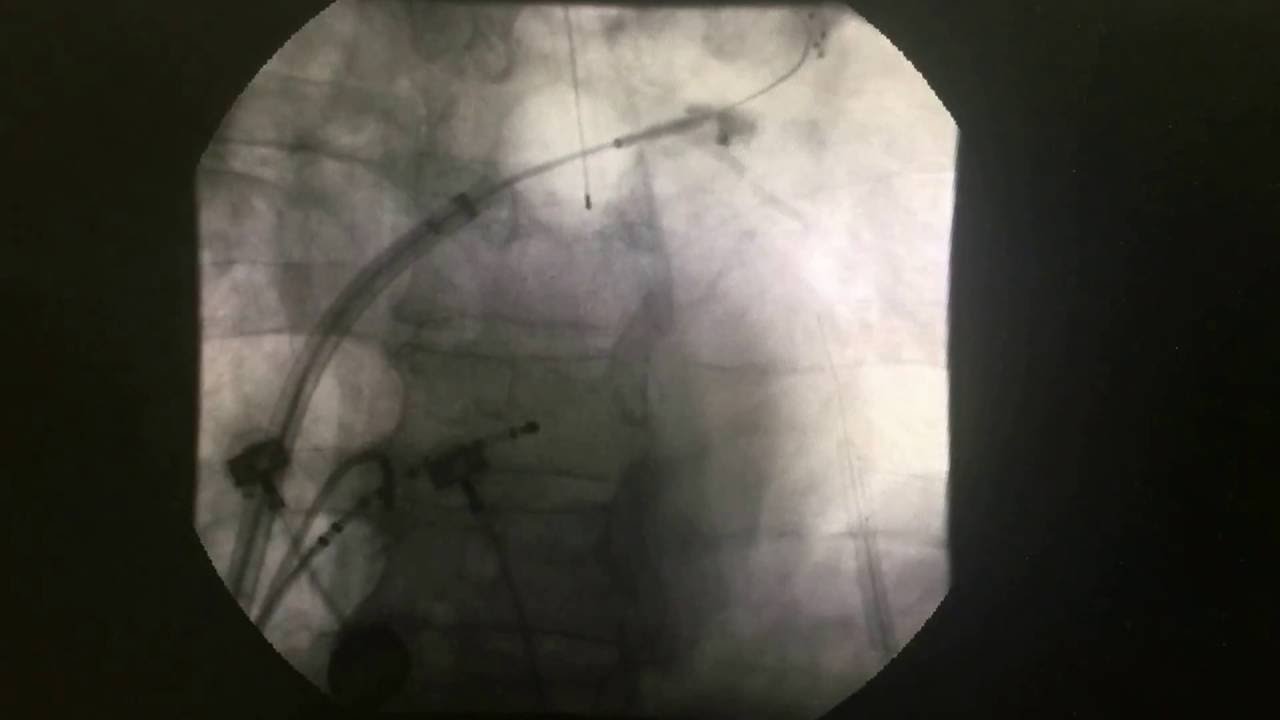 Cryoballoon ablation for Atrial Fibrillation - Ali Sovari, MD - YouTube