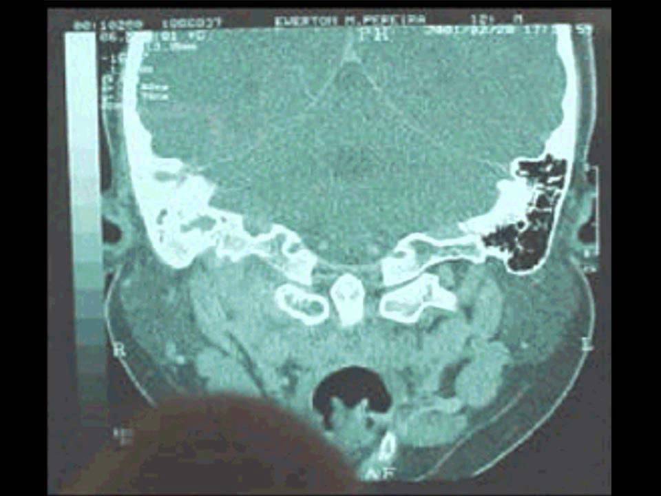 ORL Mastoïdite aigue - YouTube