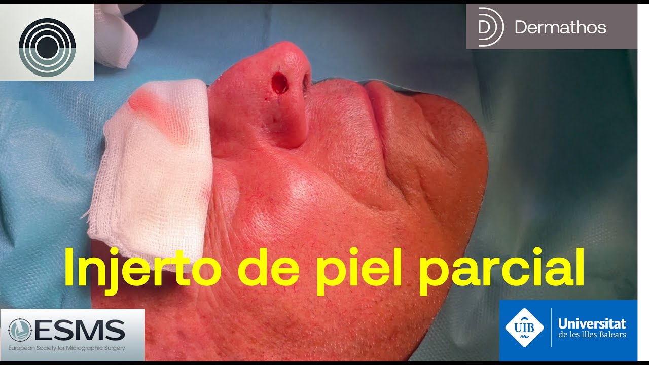 Injerto de piel parcial - YouTube
