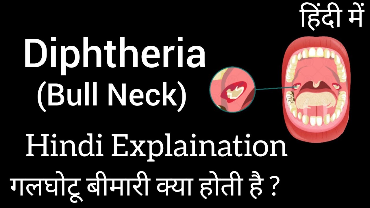 Diphtheria | Bull Neck | Hindi Explanation | Causes | Symptoms | Risk ...