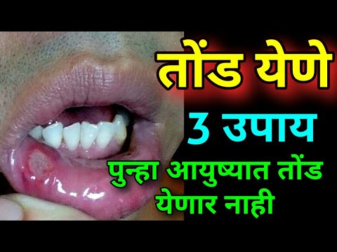 तोंड येणे वर घरगुती उपाय tond yene ayurvedic upay Mouth ulcer home ...