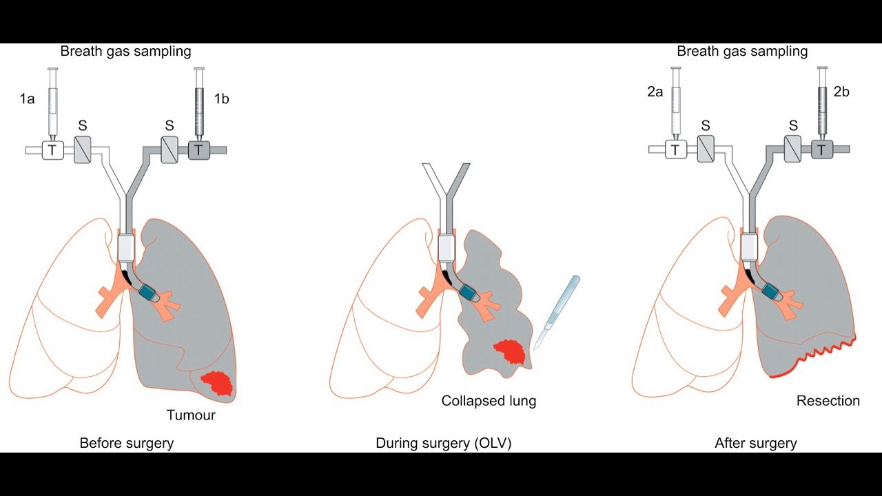 One lung ventilation - YouTube
