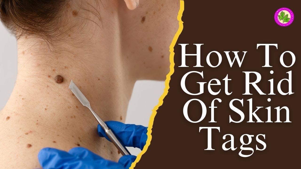 Skin Tag Removal | How To Get Rid Of Skin Tags - YouTube