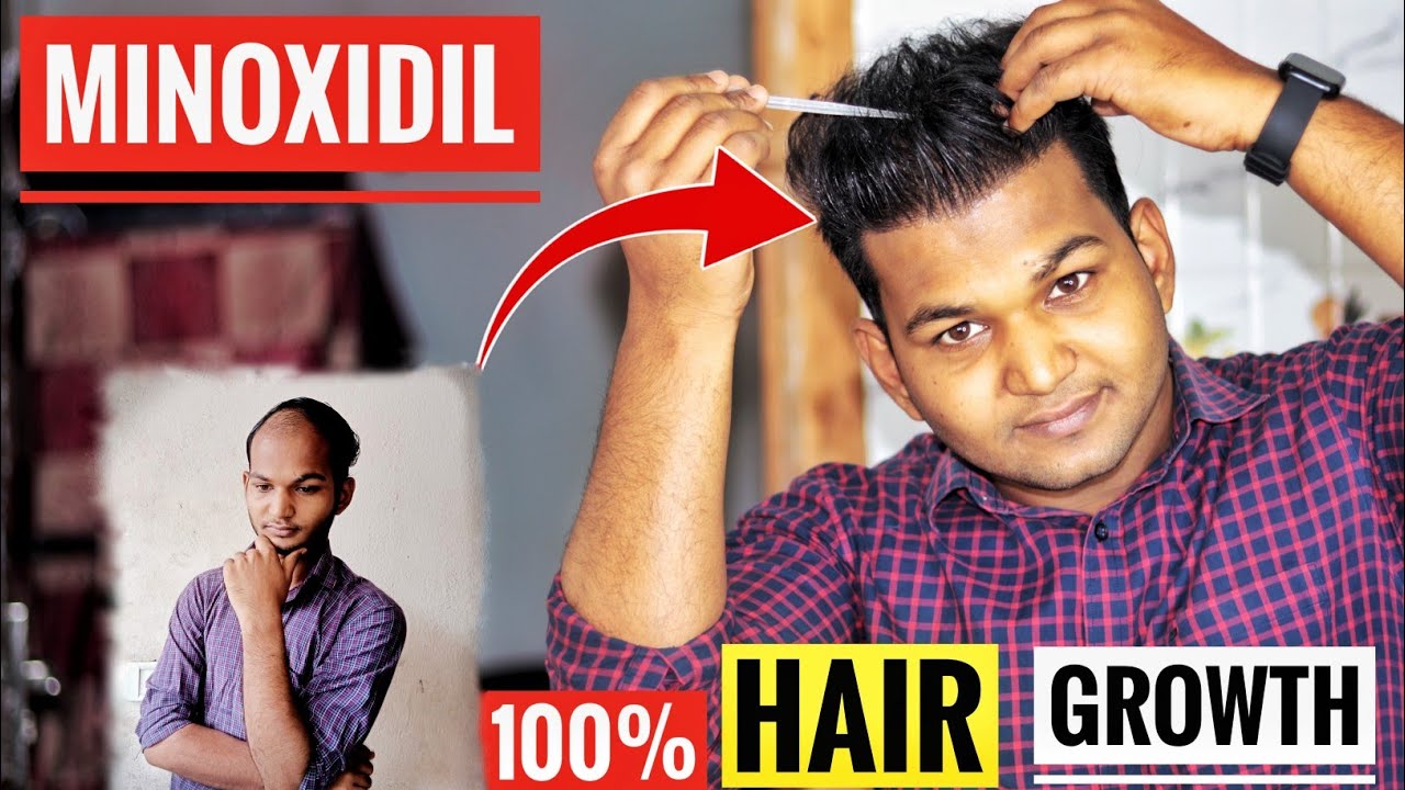 Kera FM Minoxidil Results & Review After 3 Months| My Minoxidil Results ...