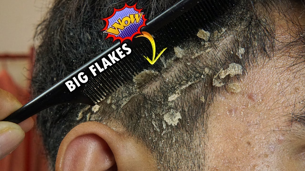 Wow! Best Dandruff Scratching Big Flakes Around Ear #447 - YouTube