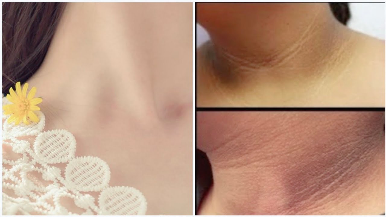 Get Rid of Black Neck fast and easy || Whitening neck permanently at ...