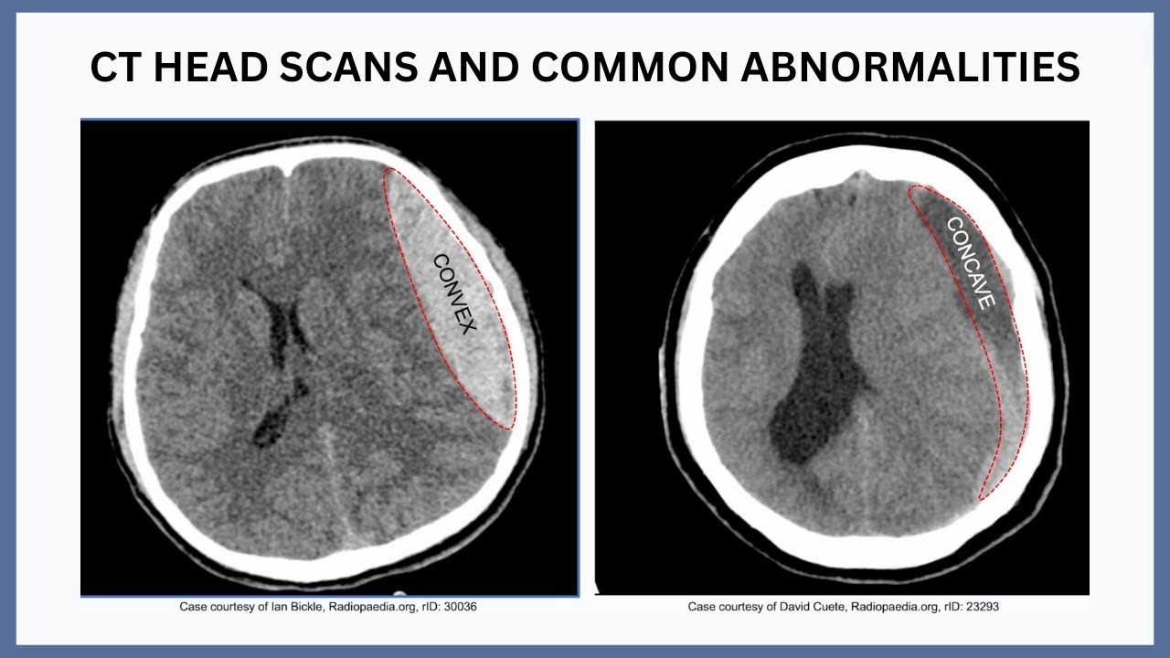 CT Head Scans and Common Abnormalities - YouTube