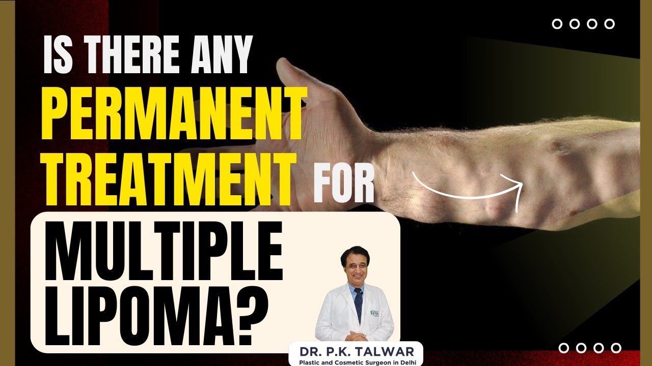 Is there any Permanent Treatment for Multiple Lipoma? Lipoma Treatment ...