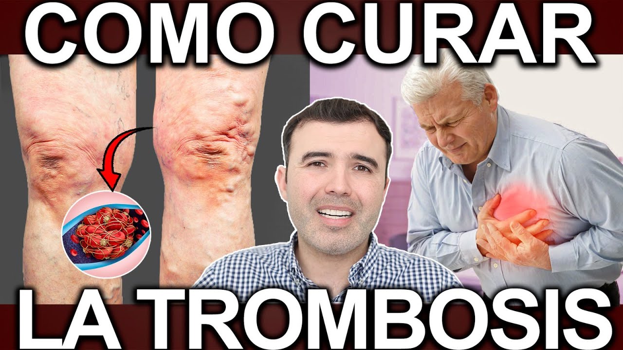 COMO CURAR LOS TROMBOS O TROMBOSIS 2025 - Diluye Los Trombos O Cuagulos ...