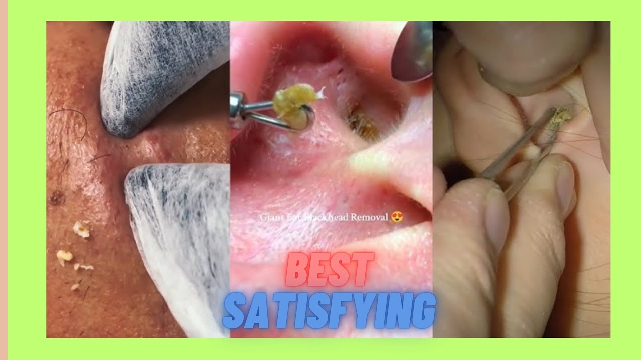 Blackhead Removal: The Most Satisfying Extraction Ever! - YouTube