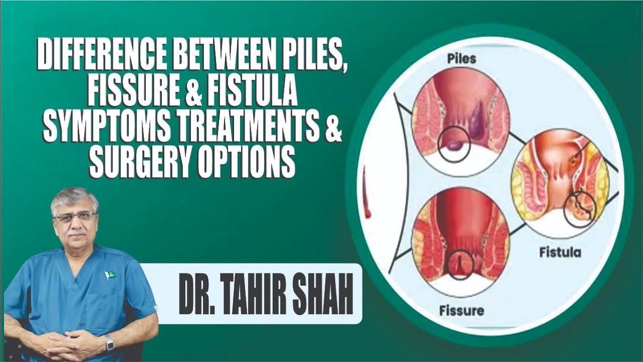 Difference Between Piles, Fissure & Fistula | Symptoms Treatments ...