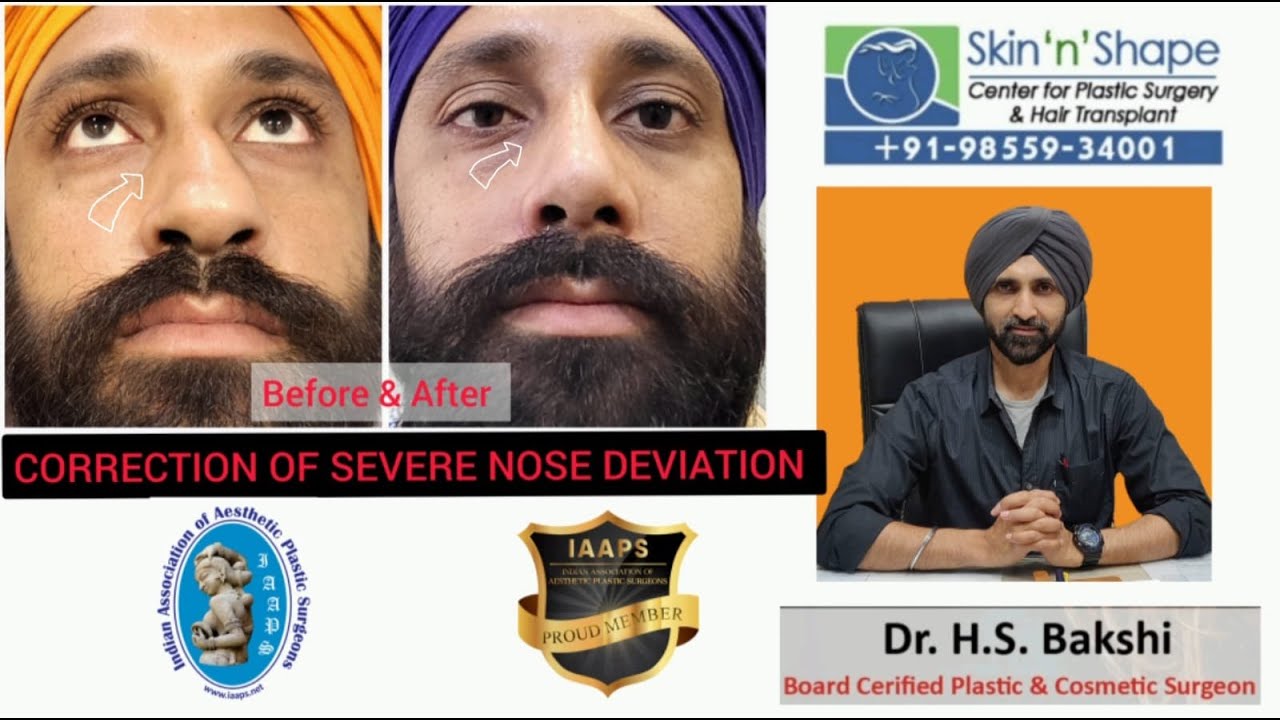 Rhinoplasty Result for Deviated Nose | Dr HS Bakshi | Skin n Shape ...