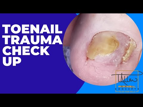 Toenail Trauma Check Up Appointment (Part One is in a Short) - YouTube