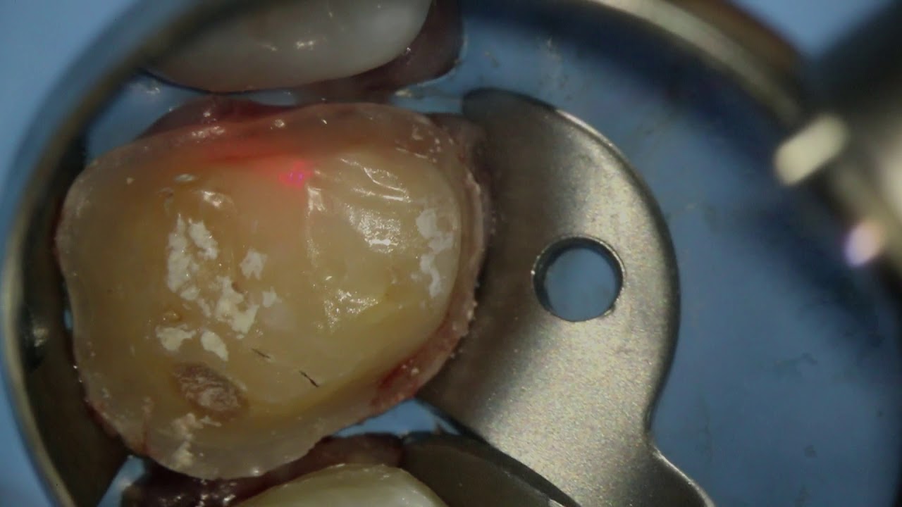 Crown Prep with LASER Etch - YouTube