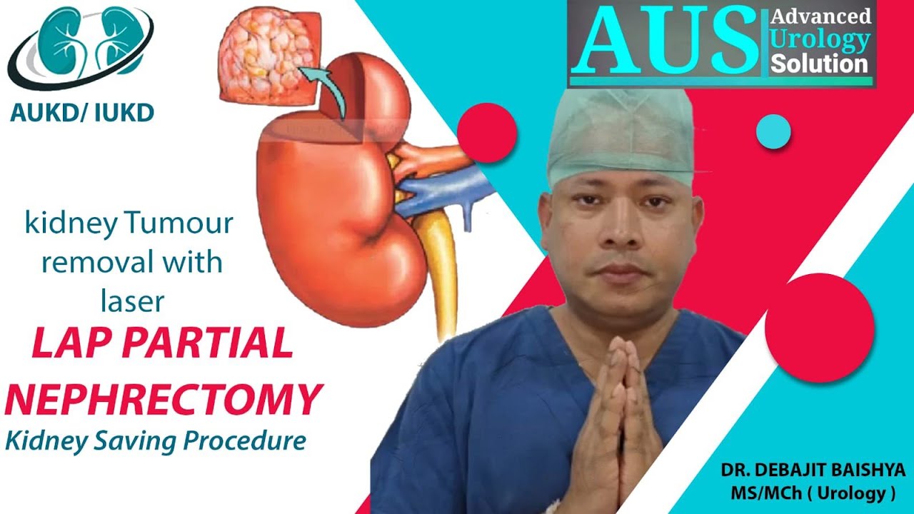 Small Kidney Tumour ll Lap Partial Nephrectomy ll Kidney Saving ...