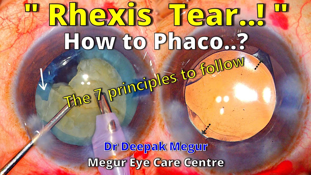 Phaco in an eye with torn Rhexis.The 7 principles to follow - Dr Deepak ...