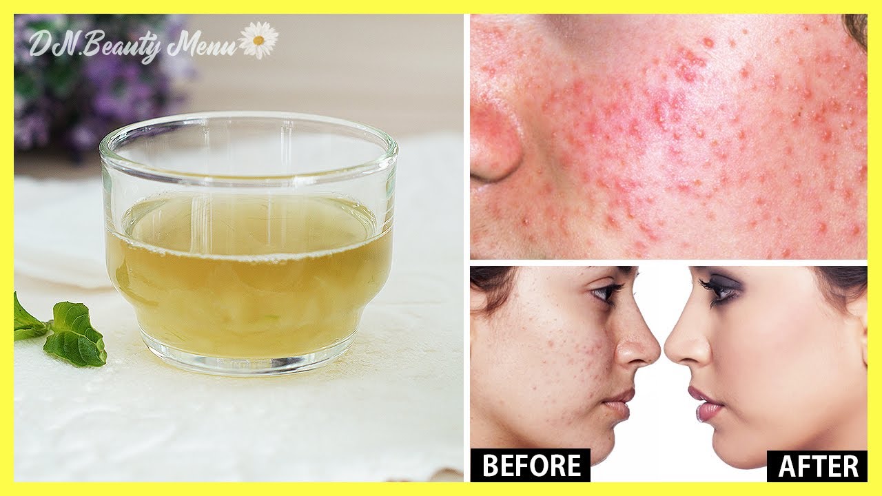 Get Rid Of Acne Redness Menu 14 Acne Treatment Natural Reduce Red get-rid-of-acne-redness-menu-14-acne-treatment-natural-reduce-red