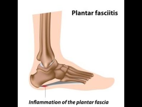 Confusing Bursitis with Plantar Fasciitis - YouTube