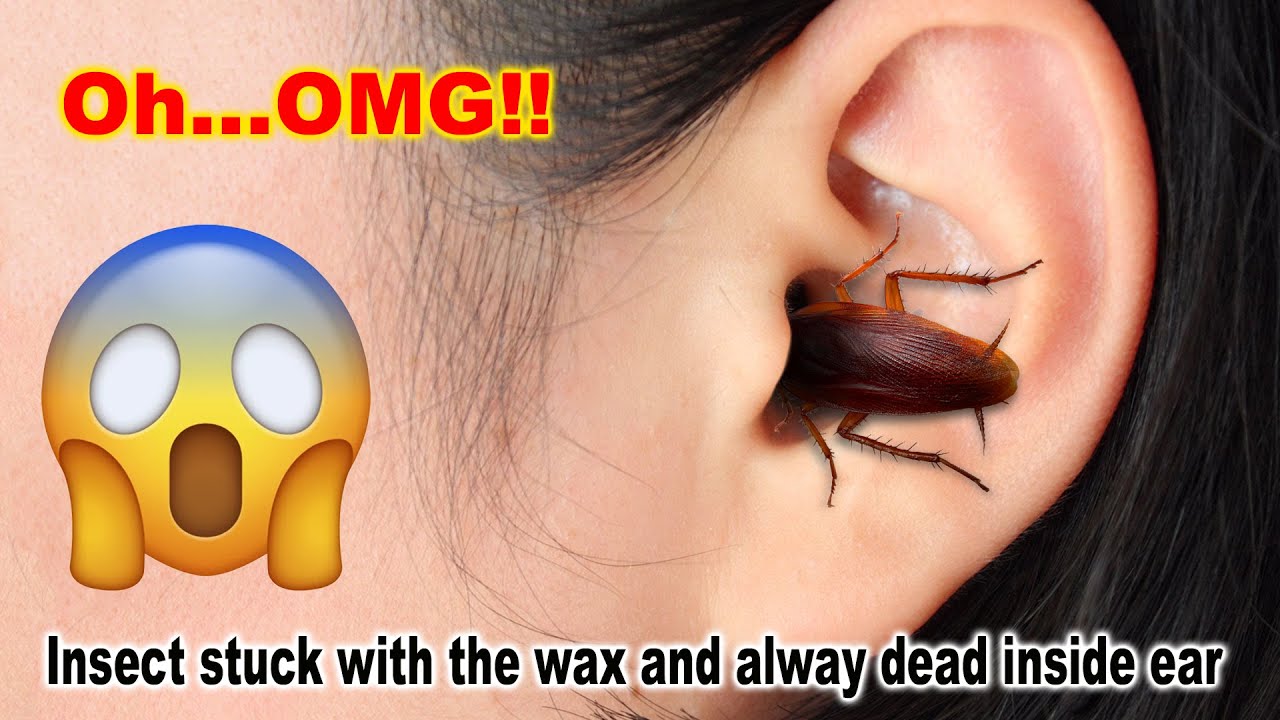 Insect stuck with the wax and alway dead inside the ear. - YouTube