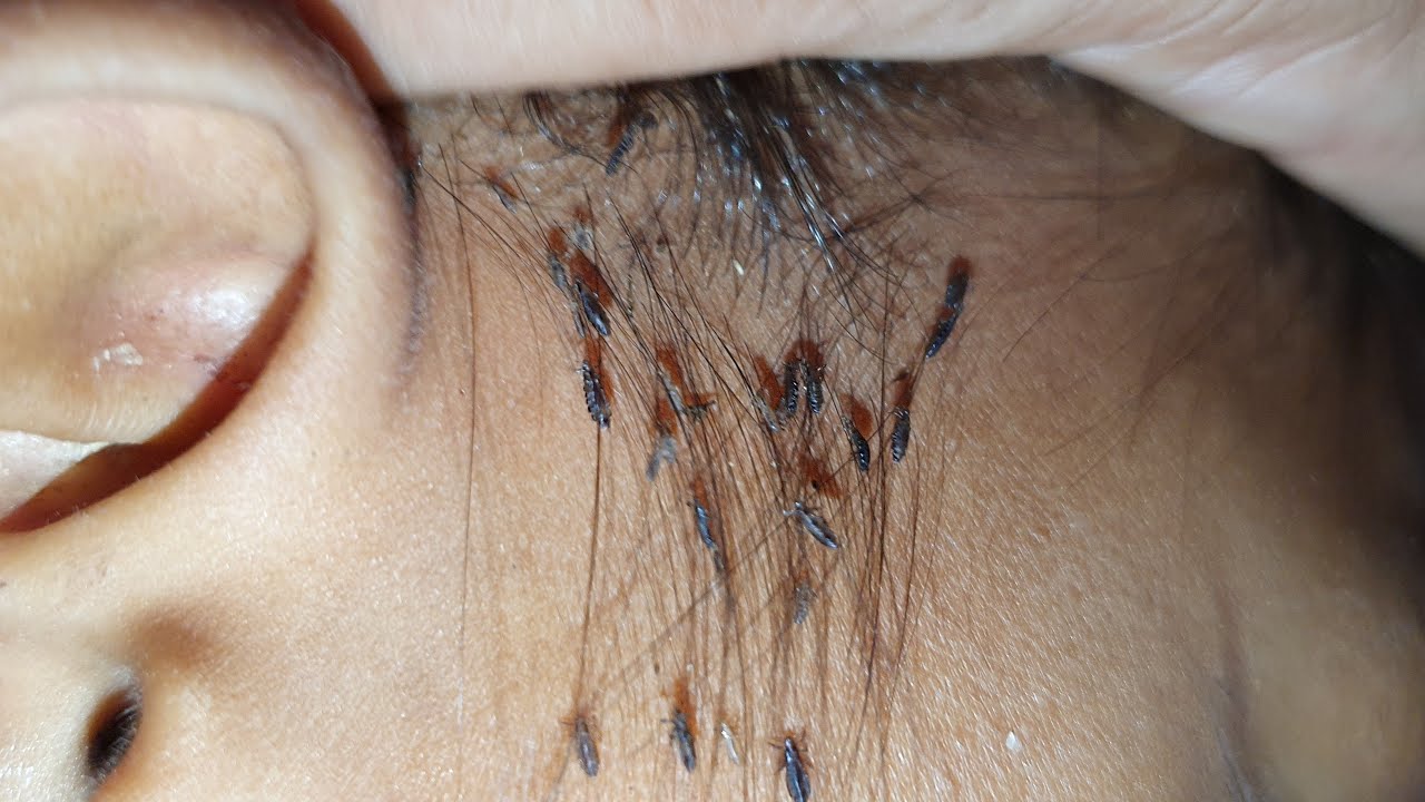 lot of big lice,Take out all lice from long hair - YouTube