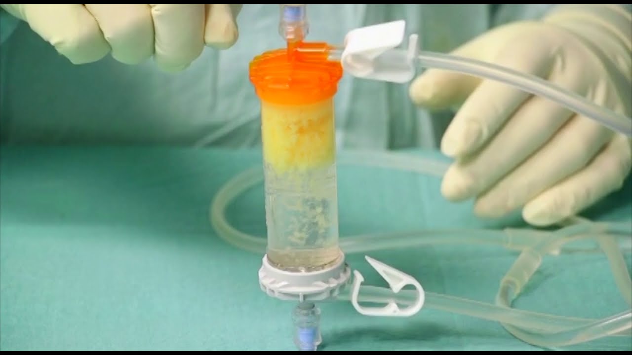 Lipogems with Arthroscopy Surgery: Dr. Claudio Zorzi and Dr. Arcangelo ...