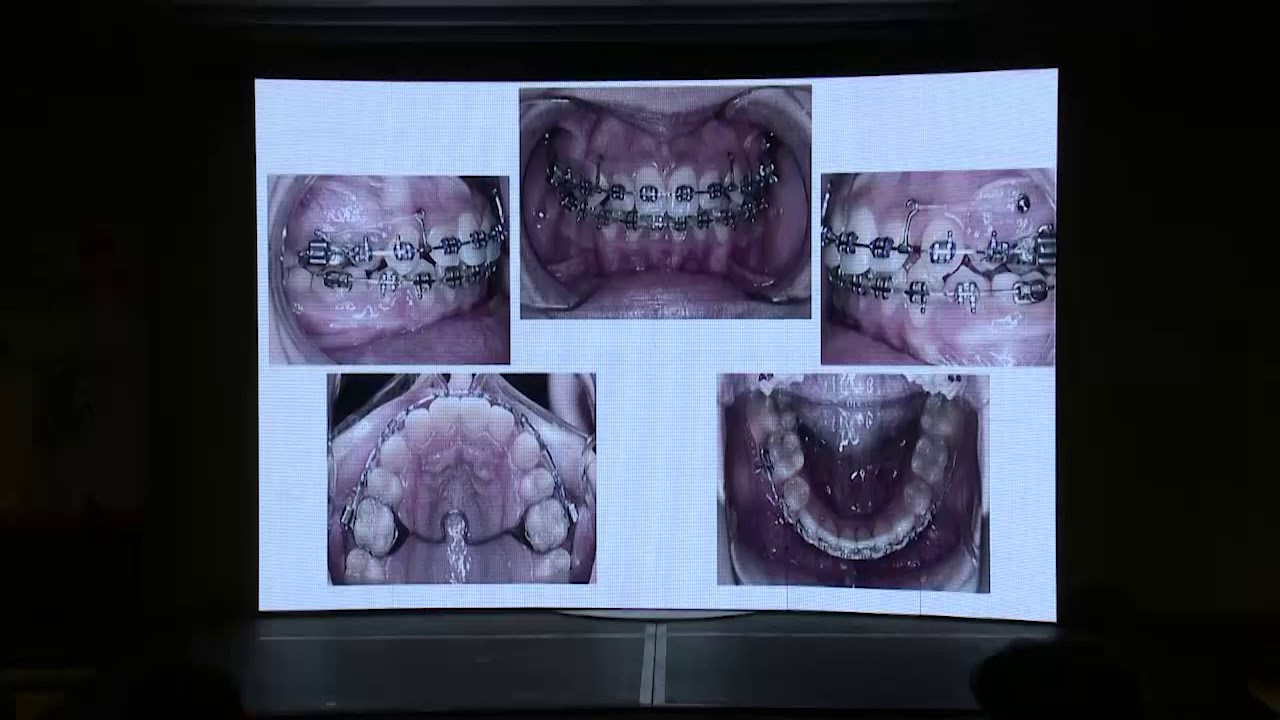 Treatment of Complicated case of Class II high angle with sever ...