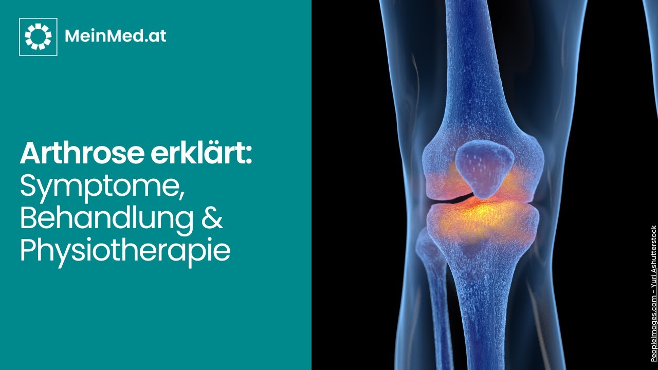 Arthrose verständlich erklärt: Symptome, Behandlung & Physiotherapie ...