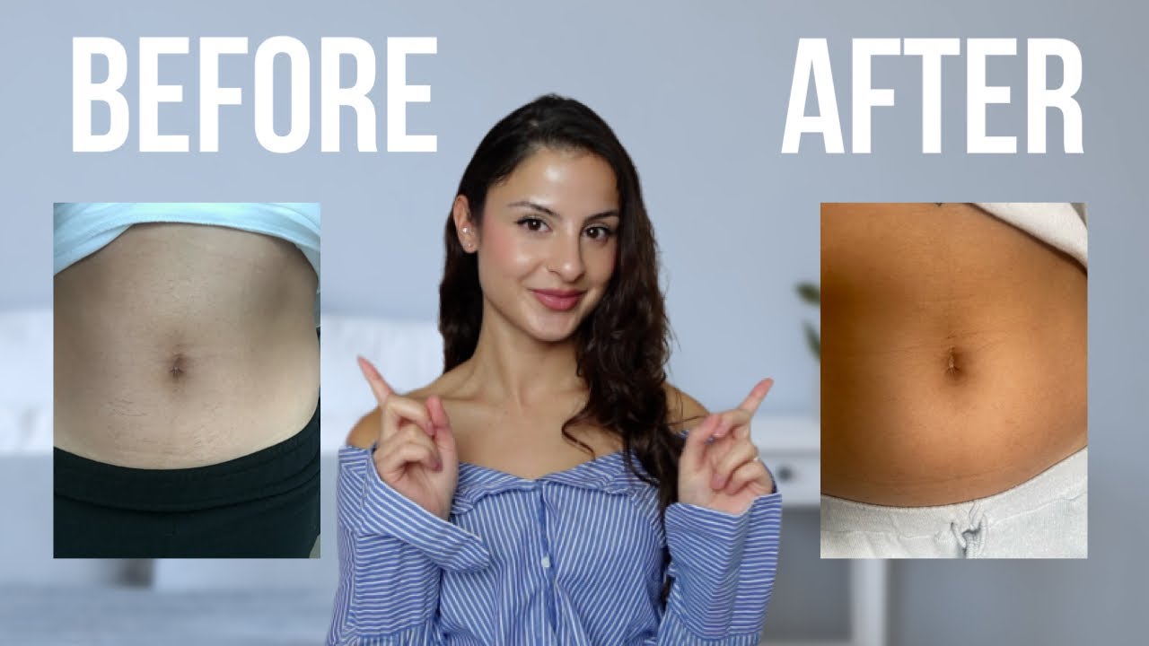 ABDOMEN HAIR REMOVAL RESULTS WITH ELECTROLYSIS - YouTube