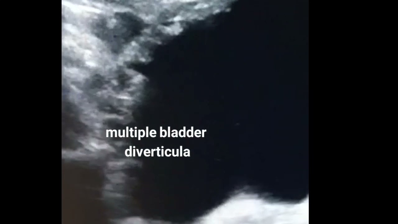 multiple bladder diverticula - YouTube