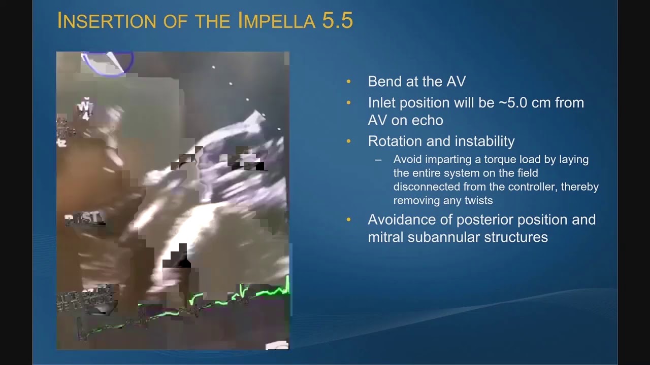 Impella 5.5 with SmartAssist: Implantation Experience - YouTube