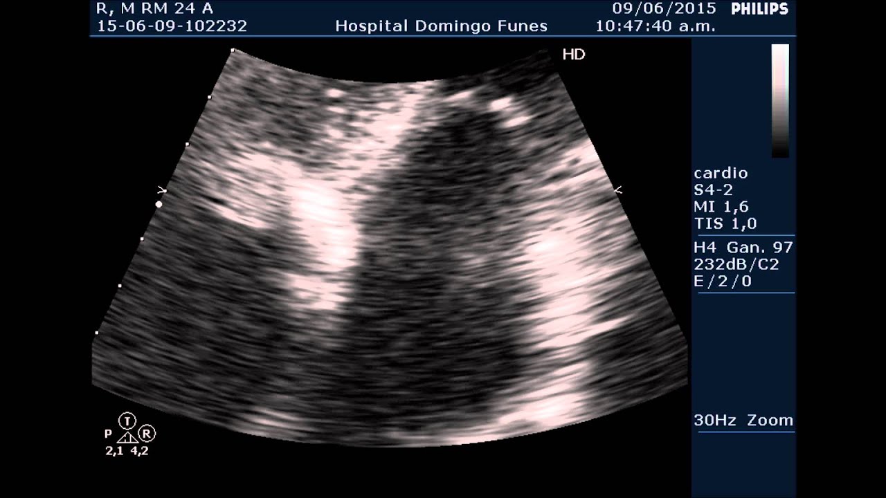 Pericarditis Constrictiva Dr PGBustos Agosto 2015 - YouTube