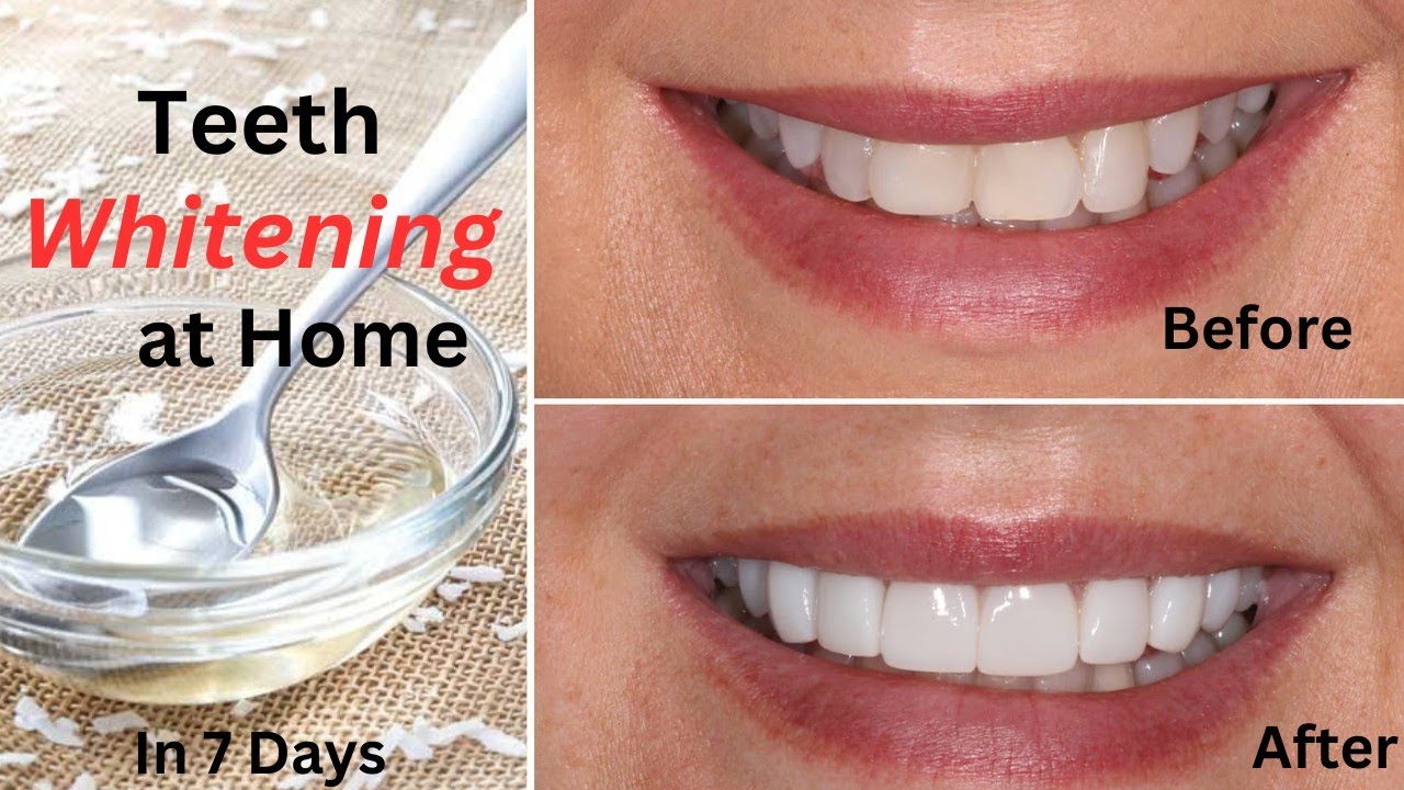 Teeth Whitening at Home | 100% effective | Teeth Whitening and Oral ...