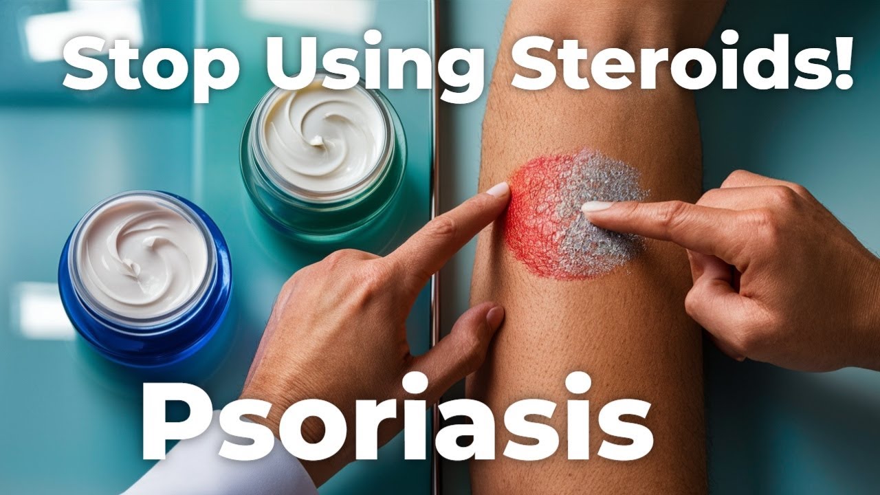 Psoriasis or the silvery scales over body , STOP Steroids - YouTube